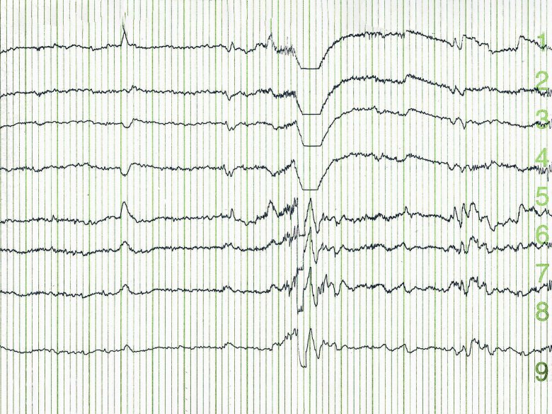 EEG biofeedback - nowa metoda terapeutyczna w psychiatrii ...